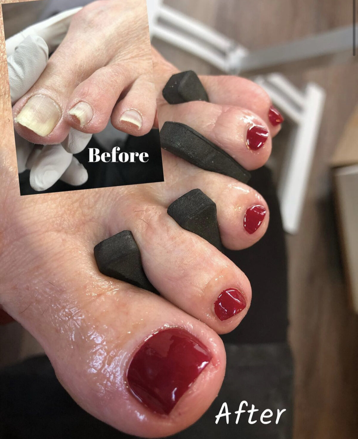 Gallery - Toe Nail Correction