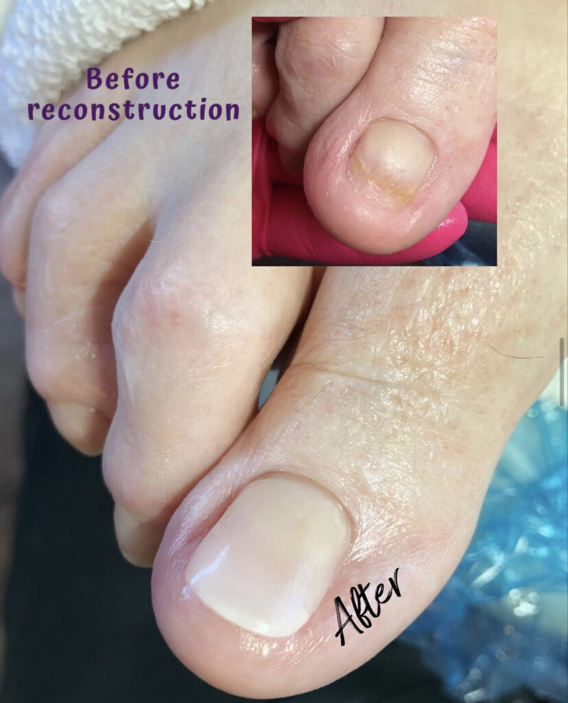 Gallery - Toe Nail Correction
