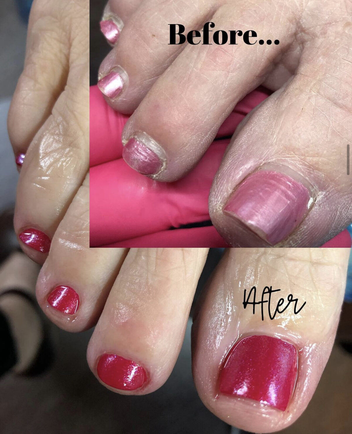 Gallery - Toe Nail Correction