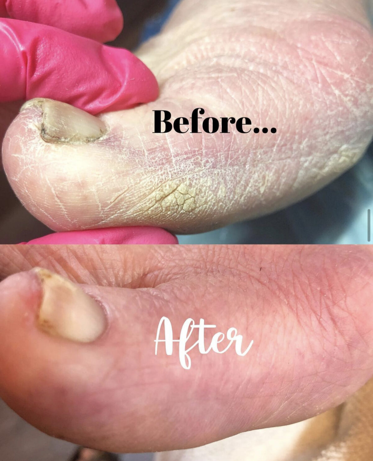 Gallery - Toe Nail Correction